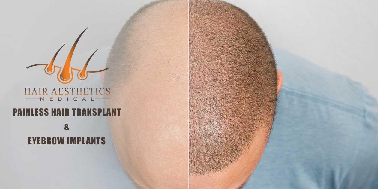 Los Angeles Hair Transplant Clinic - Eyebrow Implants - Free Evaluation